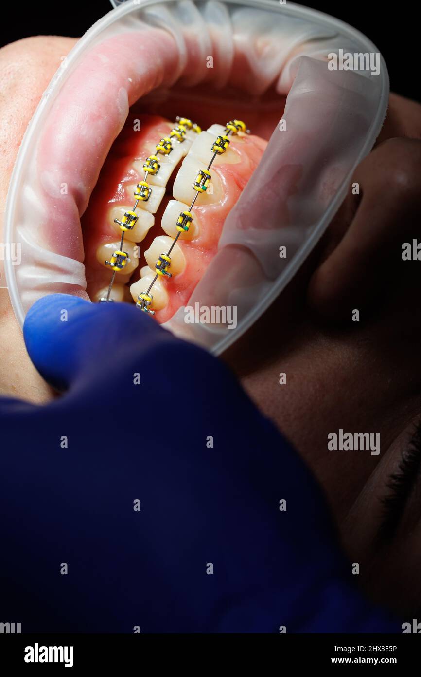 Extender for teeth. Teeth of a woman with braces at a dentist ...