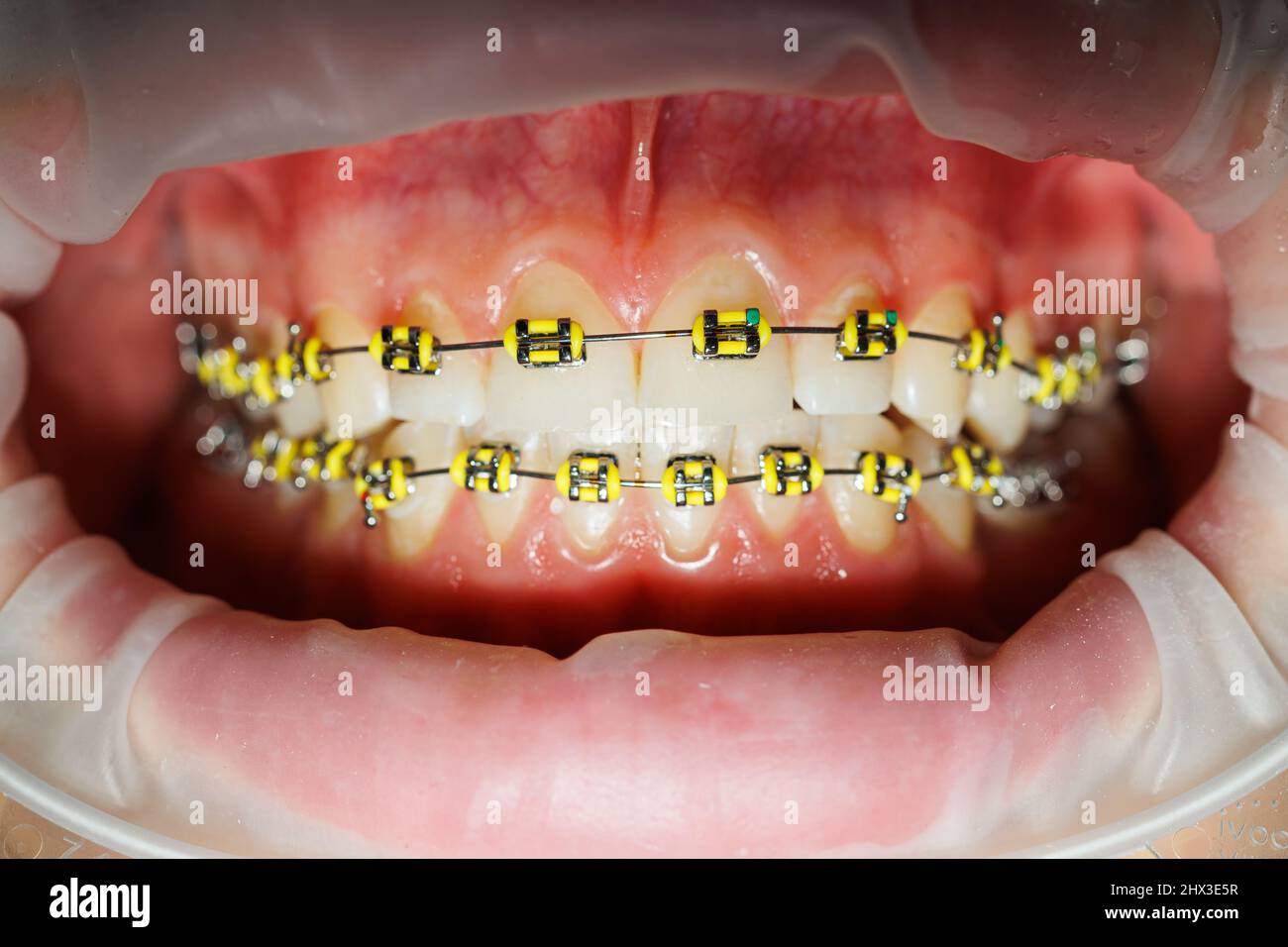 Extender for teeth. Teeth of a woman with braces at a dentist ...