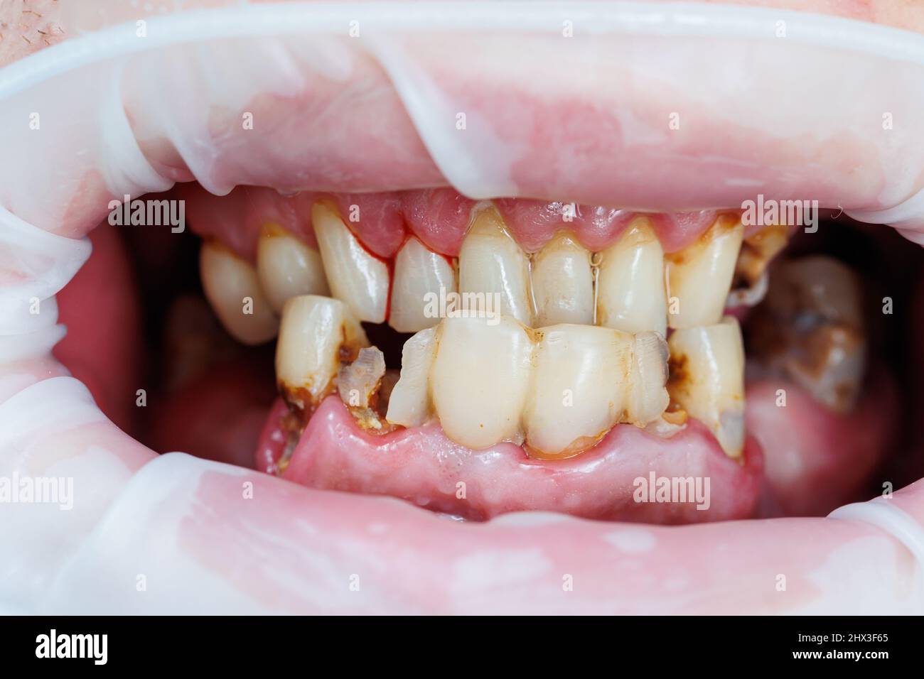 Spoiled teeth, poor dental hygiene, caries, Mouth disease. shattered ...