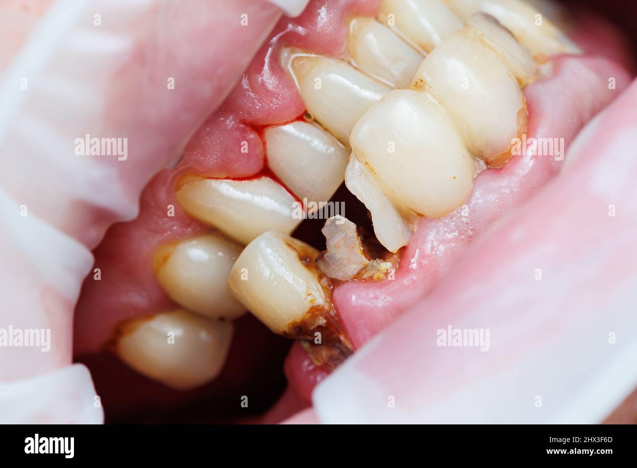 Spoiled teeth poor dental hi-res stock photography and images - Alamy