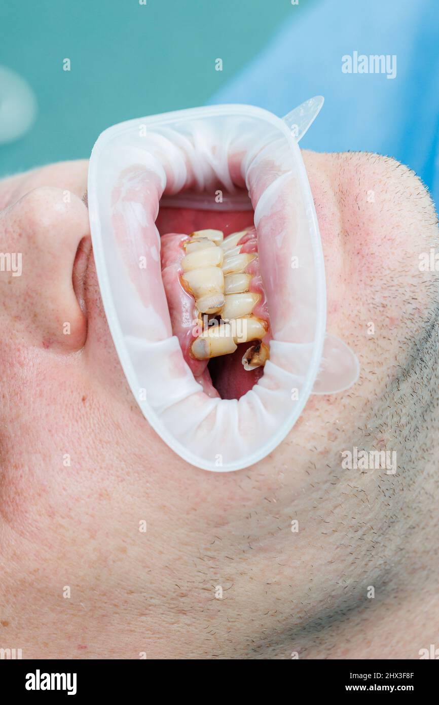 Spoiled teeth, poor dental hygiene, caries, Mouth disease. shattered ...