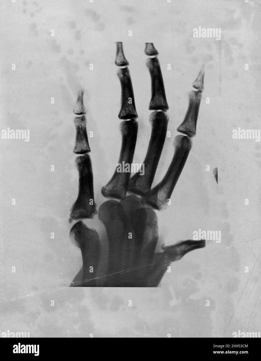 Xray of Cecil Schoonmaker's left hand showing damaged area at base of ...