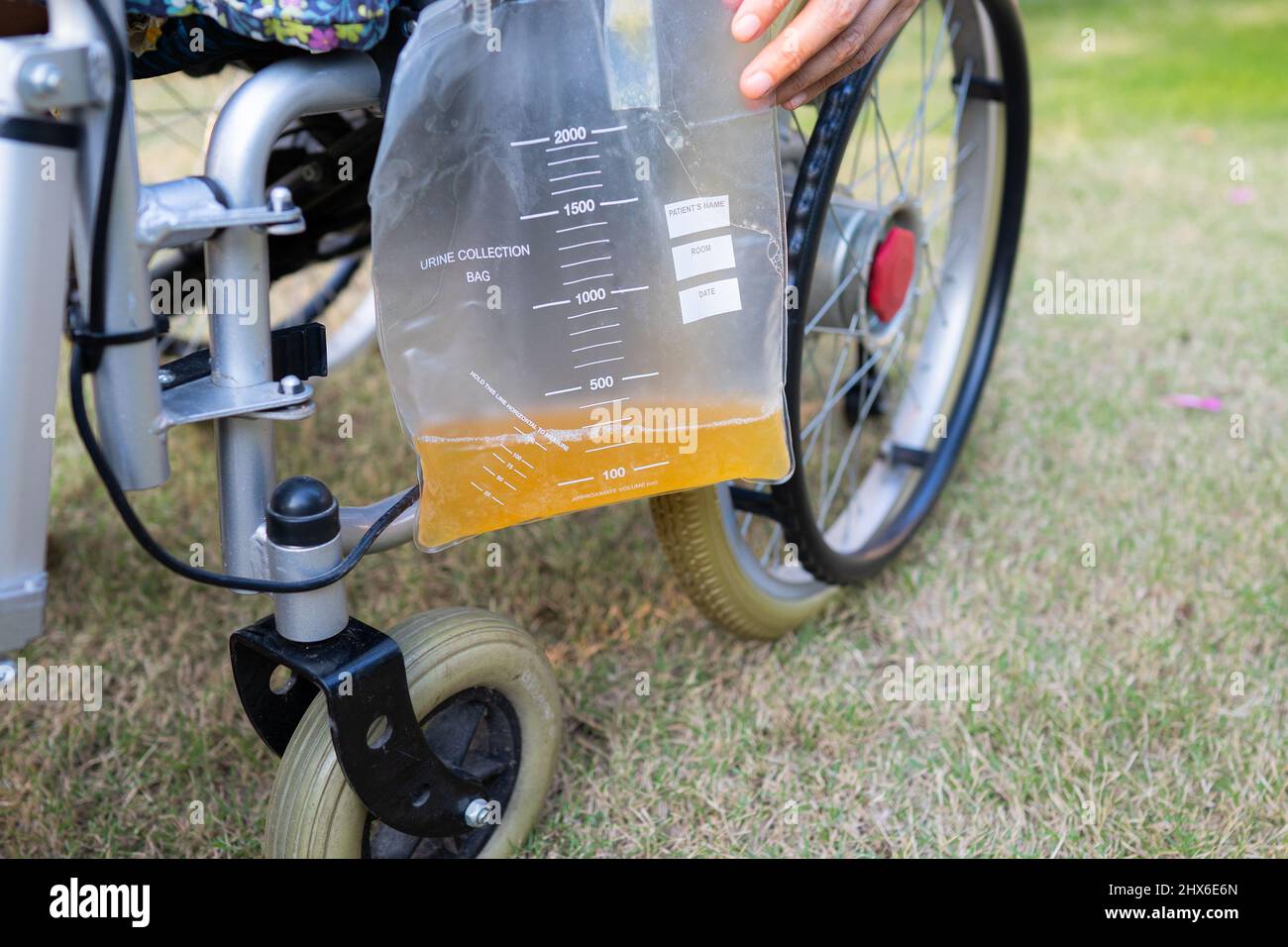 Asian lady patient sitting on wheelchair with urine catheter drainage ...