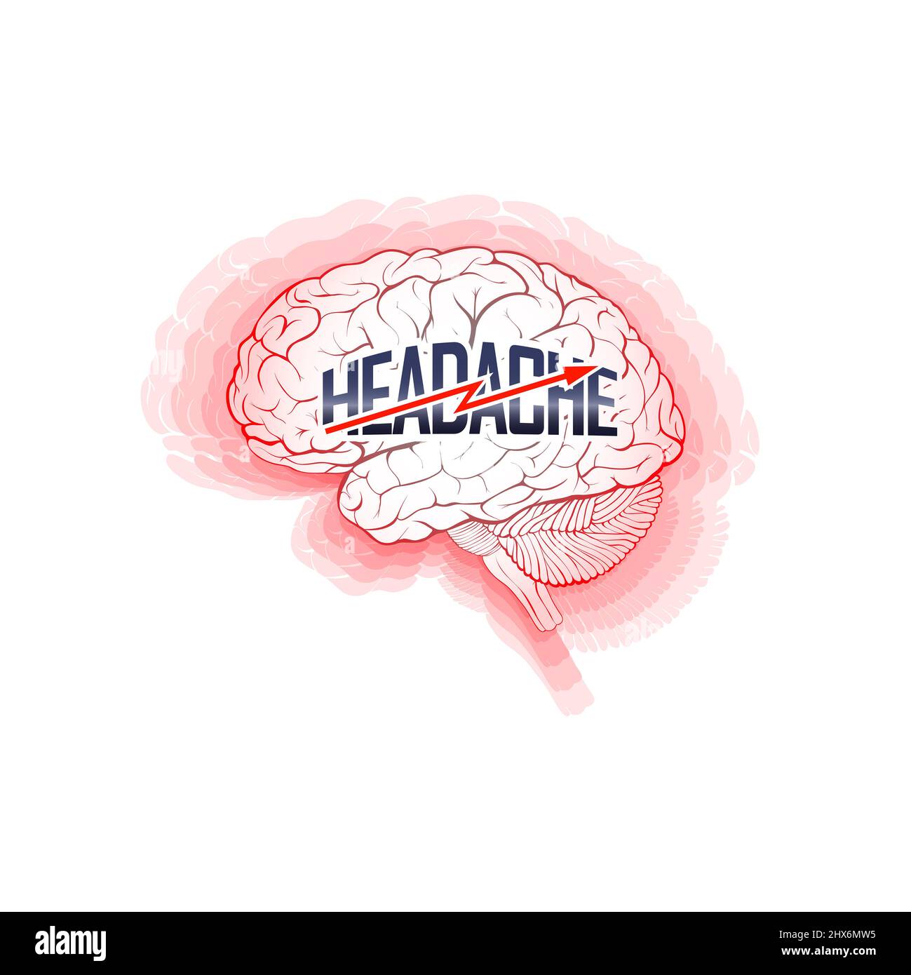 Headache concept depicting inflamed brain disease. Illustration ...