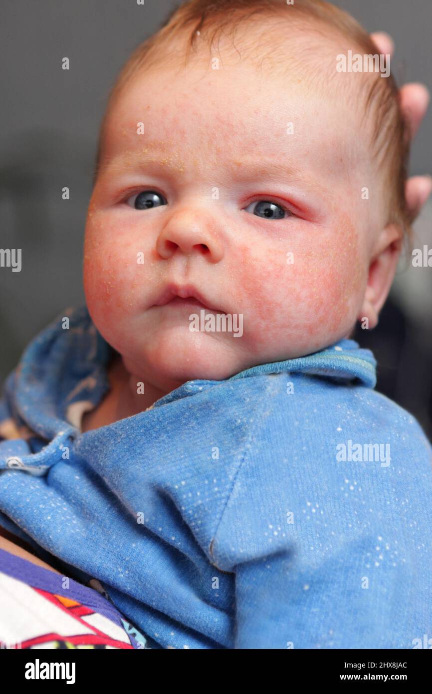 Eczema Face Baby