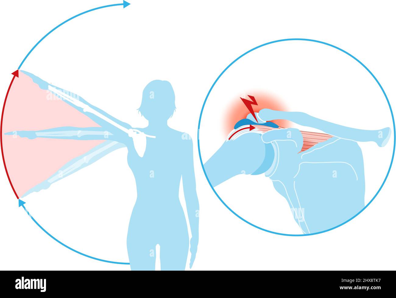Illustration showing shoulder impingement syndrome and painful arc ...