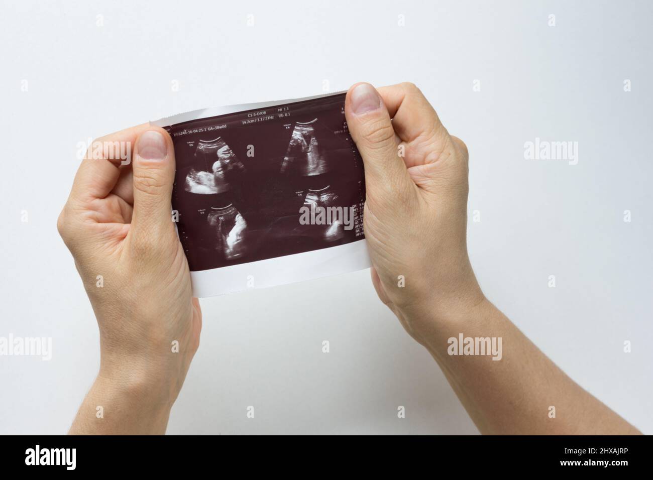 Woman hands holding picture of ultrasound of embryo on the white ...