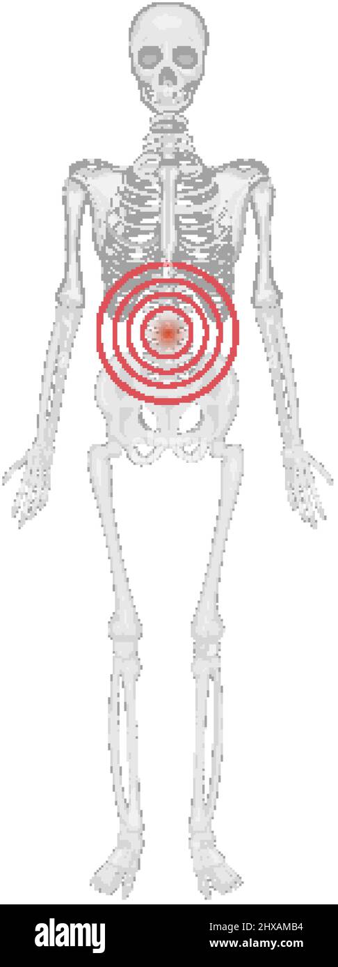 Skeleton lower back suffering from ankylosing spondylitis illustration ...