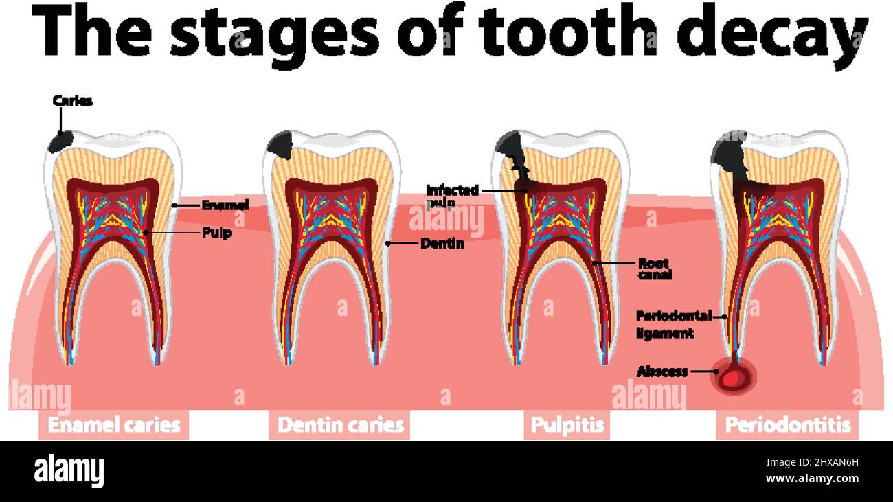 Tooth Decay Diagram