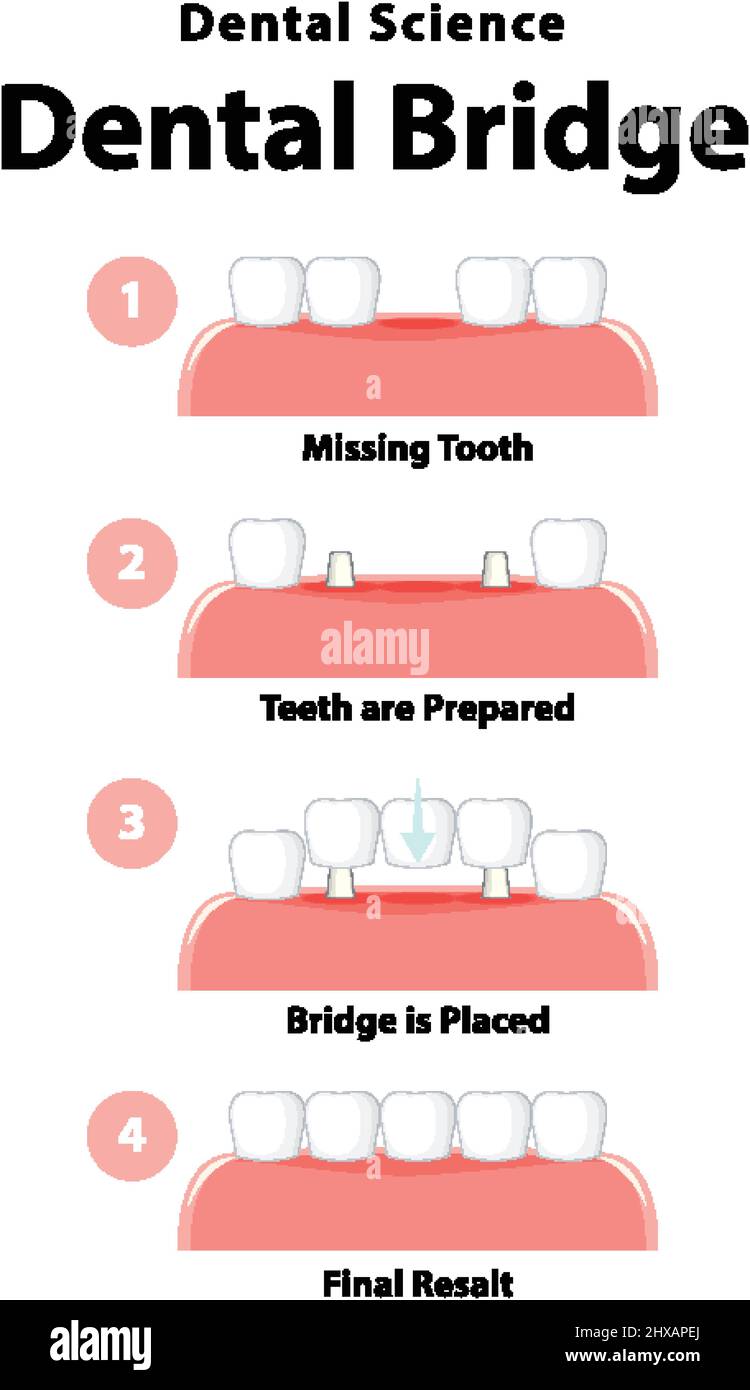 Structure of the dental bridge hi-res stock photography and images - Alamy