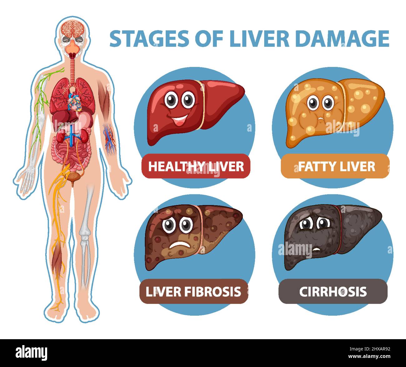 Diagram showing stages of liver damage illustration Stock Vector Image ...