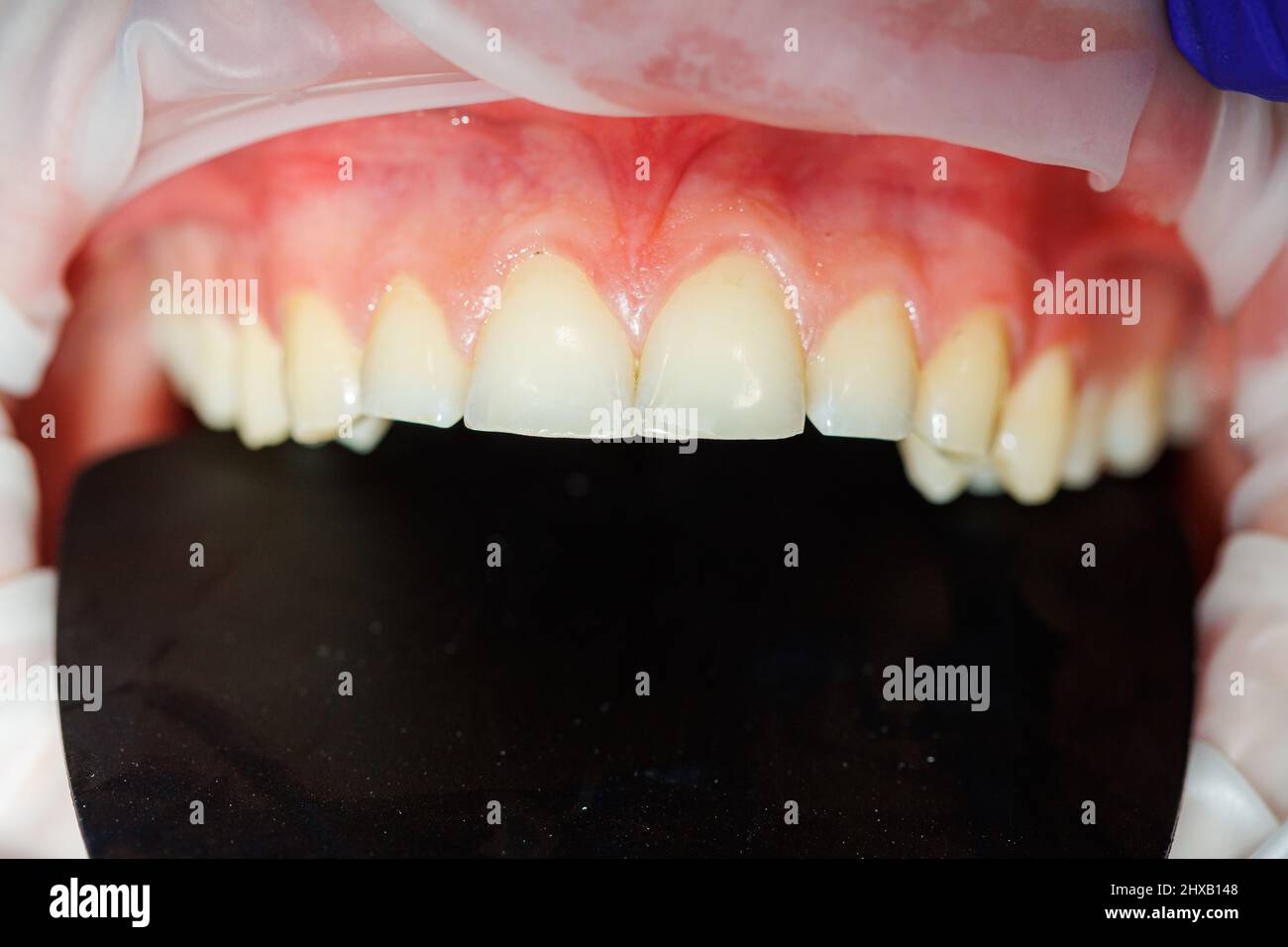 Close-up of teeth, dental checkup in the dental office. The dentist ...