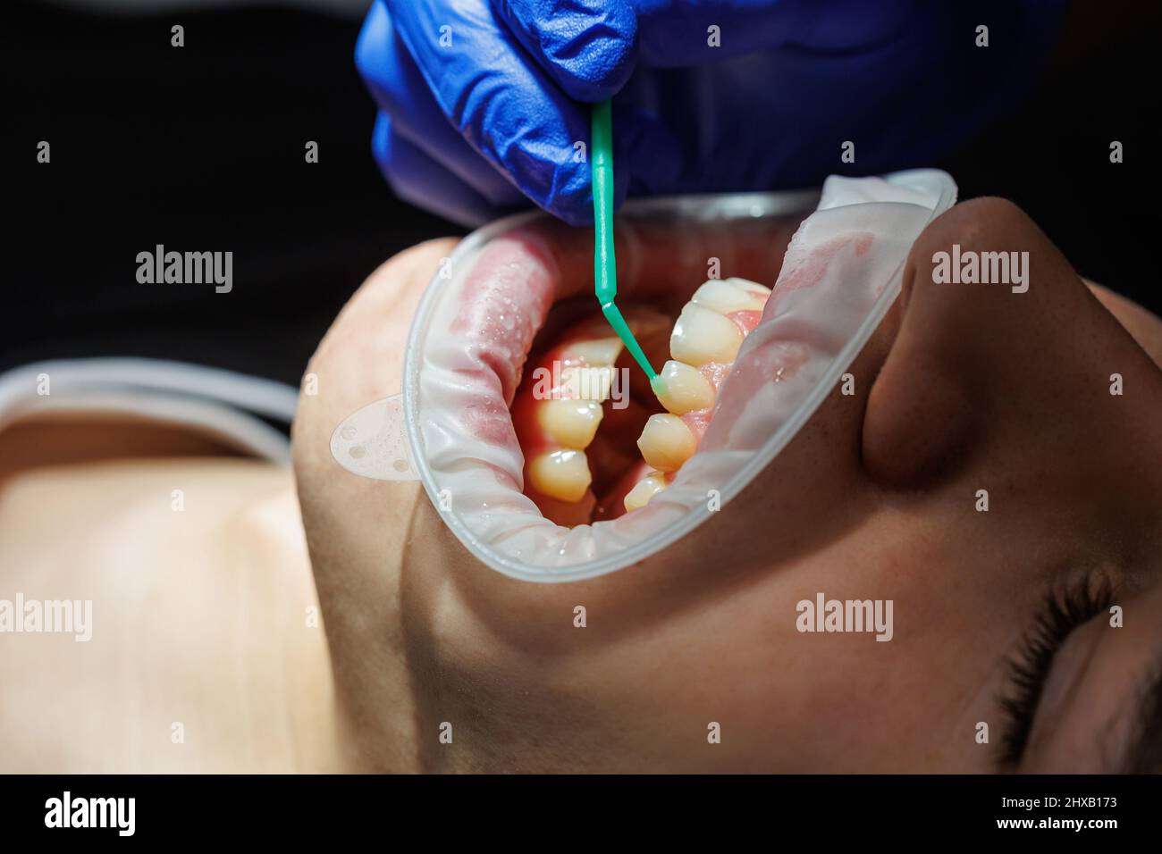 Close-up of teeth, dental checkup in the dental office. The dentist ...
