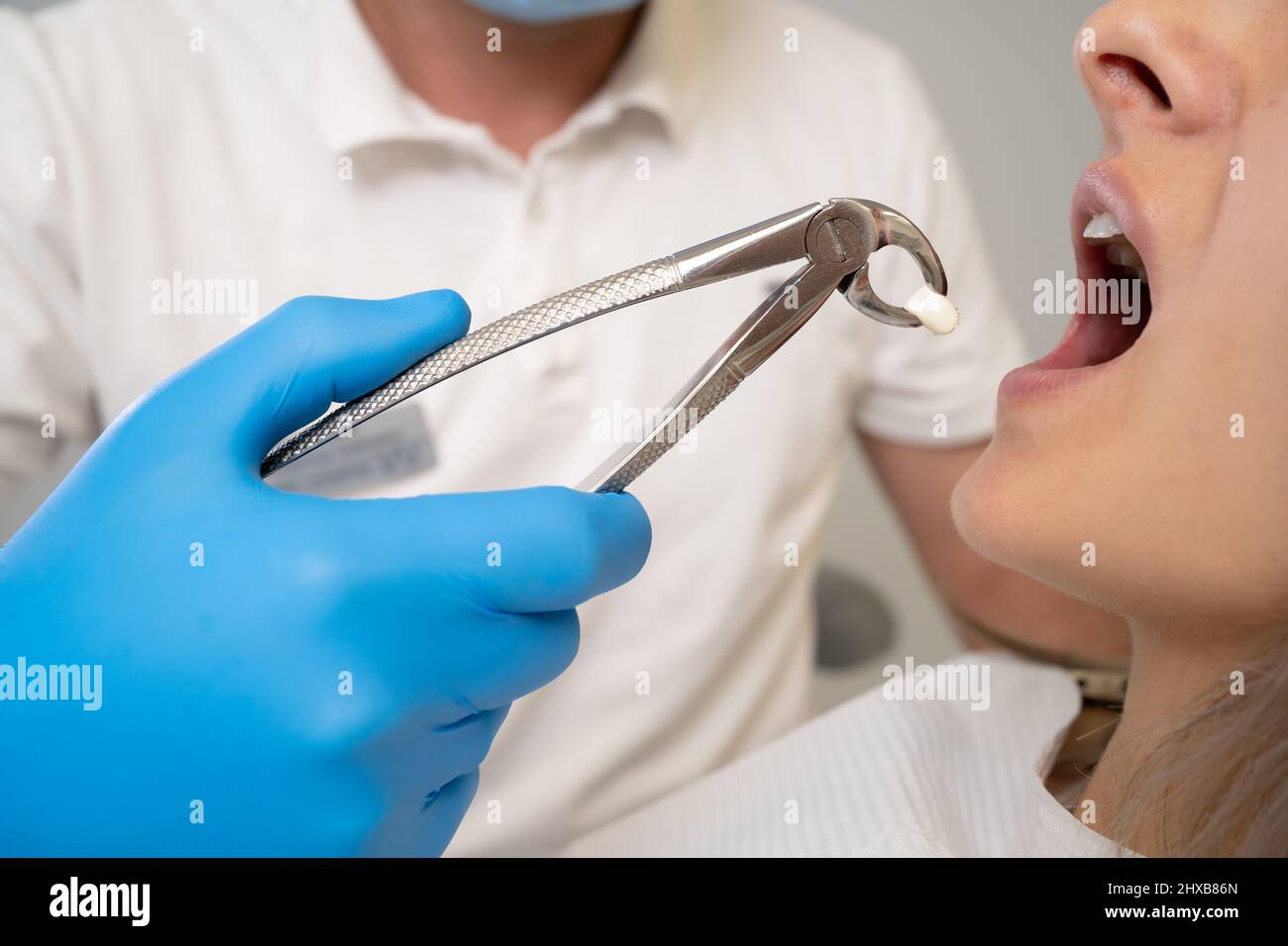 Close-up of the process of removing a tooth from the oral cavity. The ...