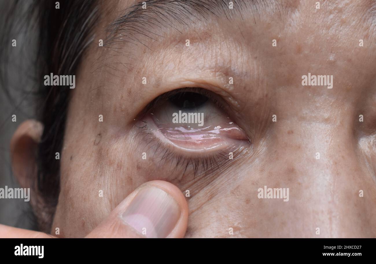 Pale skin of Asian elderly woman. Sign of anemia. Pallor at eyelid ...