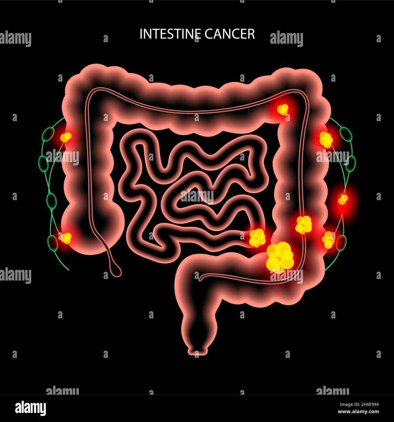 Colorectal cancer, illustration Stock Photo - Alamy