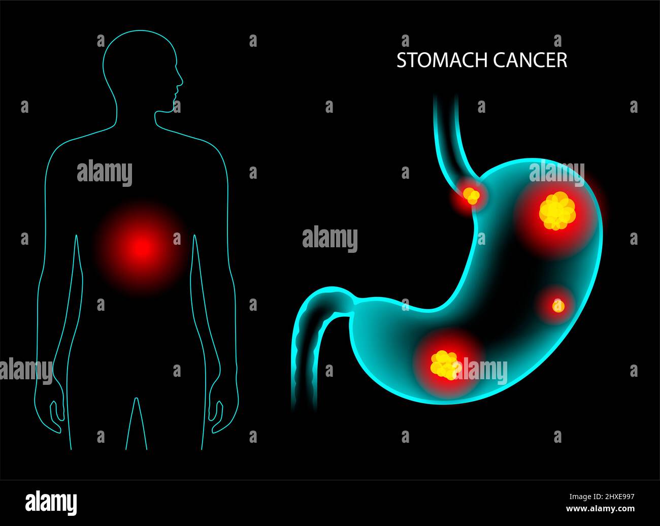 Stomach cancer, illustration Stock Photo - Alamy