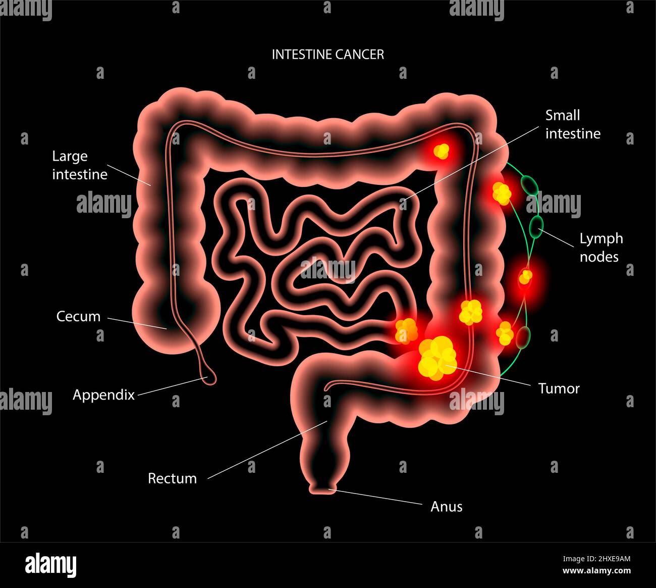 Colorectal cancer, illustration Stock Photo - Alamy
