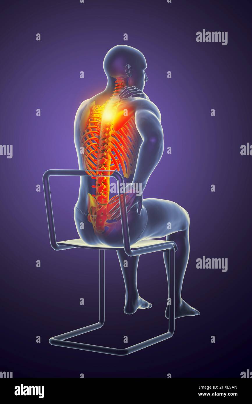 Back pain, conceptual illustration Stock Photo - Alamy