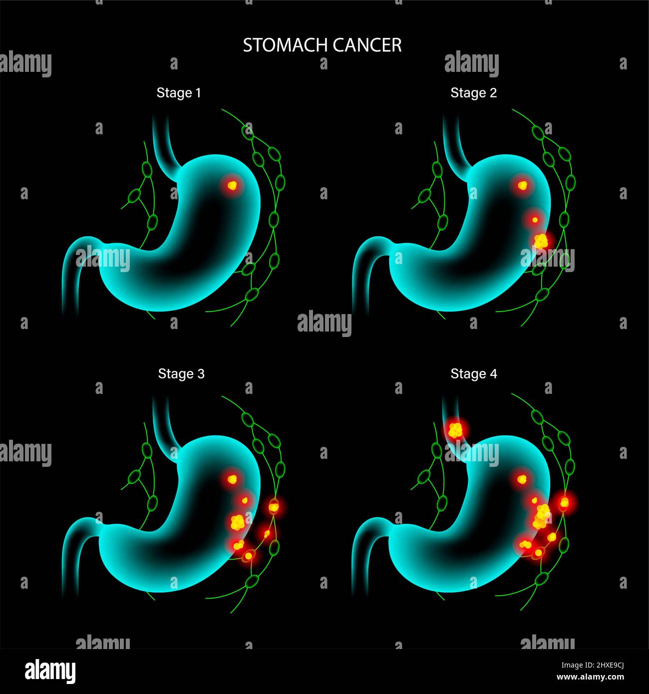 Stomach cancer, illustration Stock Photo - Alamy