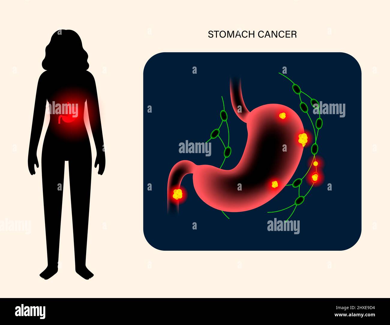 Stomach cancer, illustration Stock Photo - Alamy