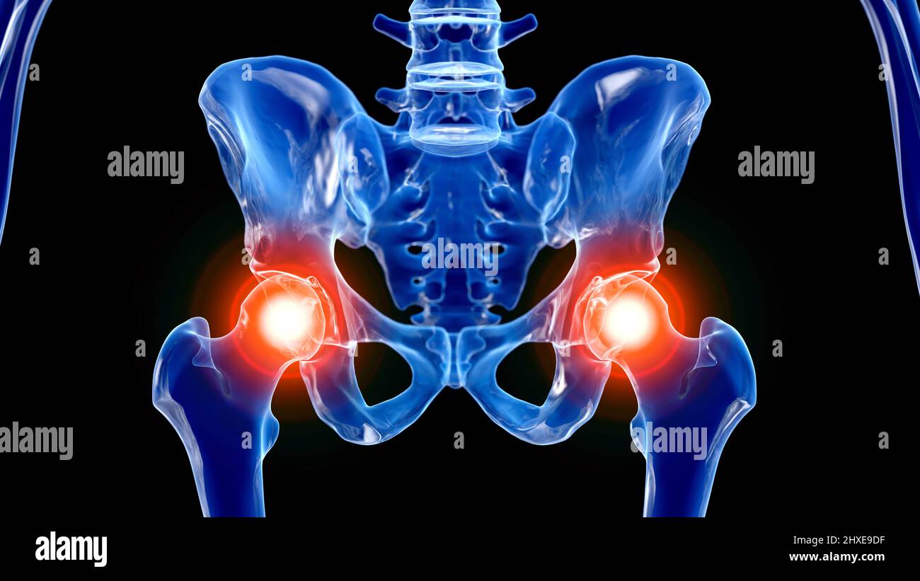 Hip joint infection hi-res stock photography and images - Alamy