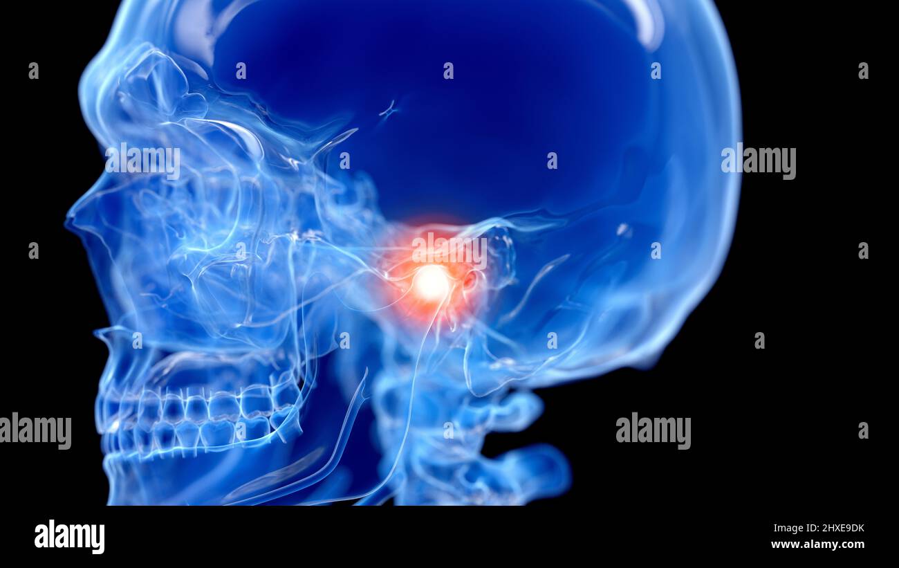 Temporomandibular joint disorder hi-res stock photography and images ...