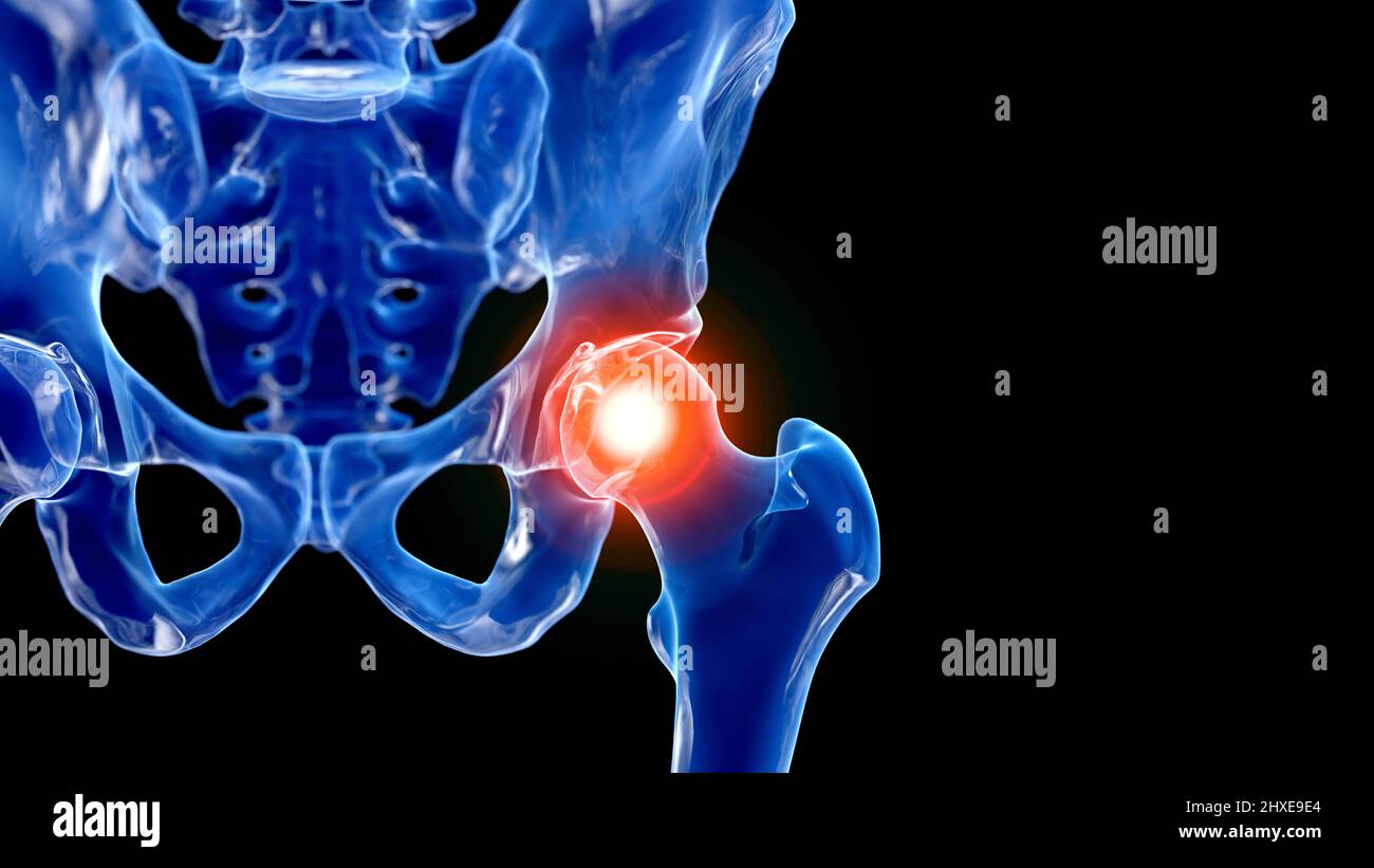 Hip joint infection hi-res stock photography and images - Alamy
