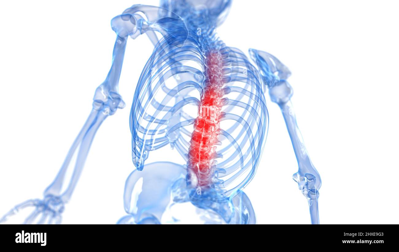 Painful spine, illustration Stock Photo - Alamy