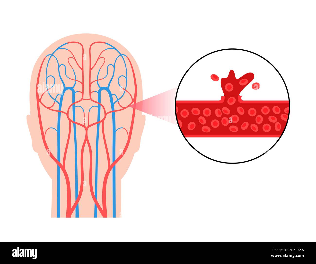 Haemorrhagic stroke, illustration Stock Photo - Alamy