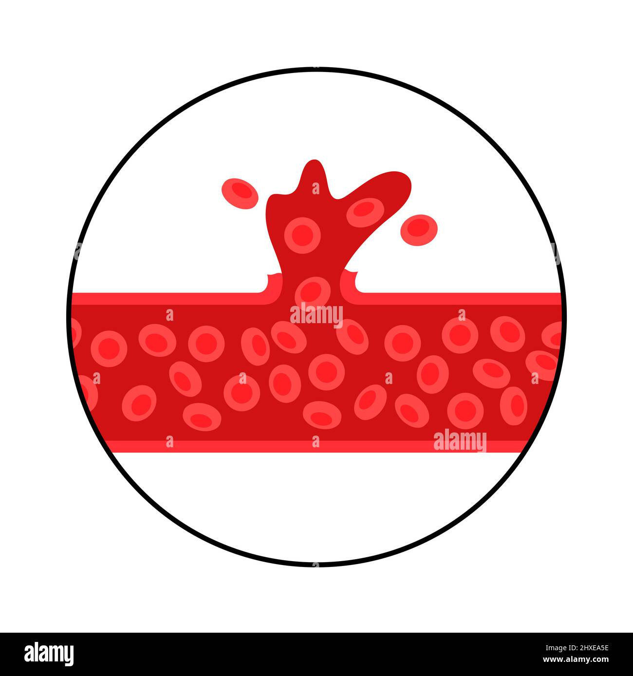 Haemorrhagic stroke, illustration Stock Photo - Alamy