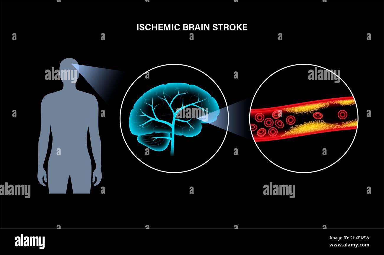 Ischaemic stroke, illustration Stock Photo - Alamy