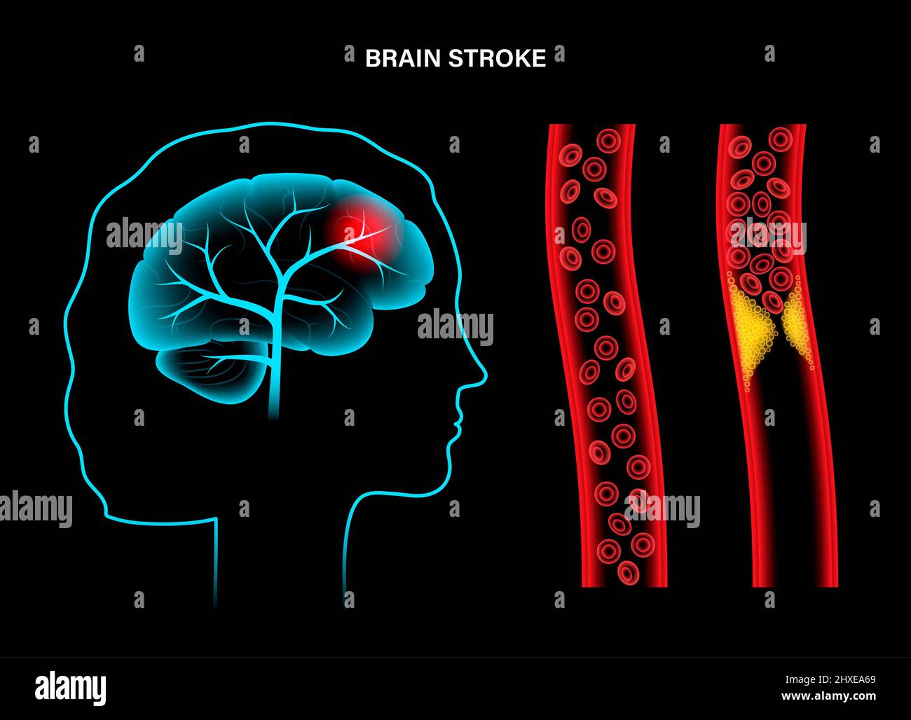 Ischaemic stroke, illustration Stock Photo - Alamy