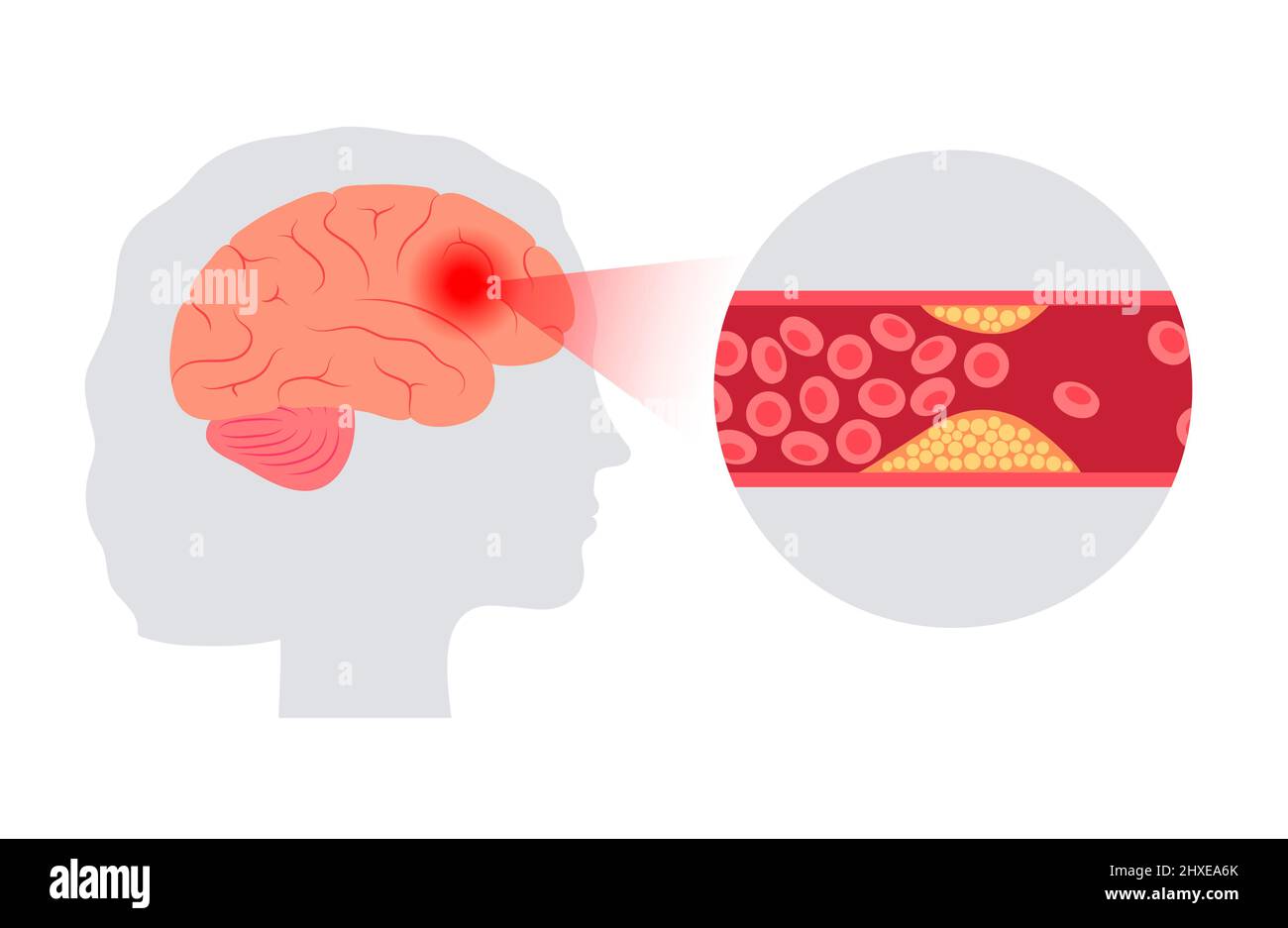 Ischaemic stroke, illustration Stock Photo - Alamy