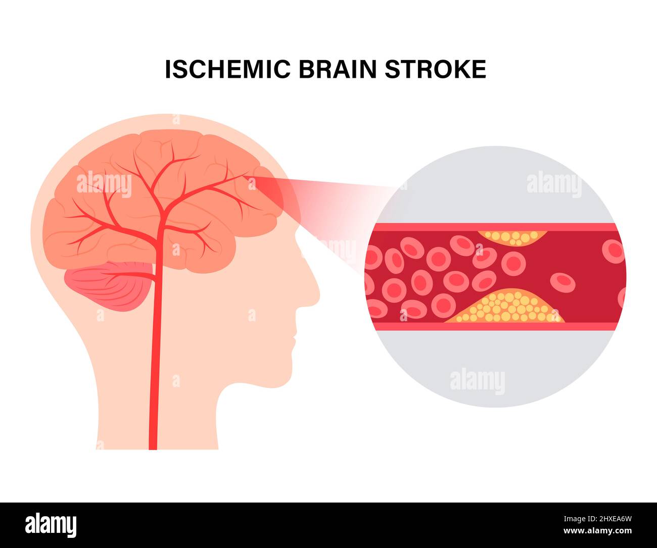 Ischemic Stroke Animation