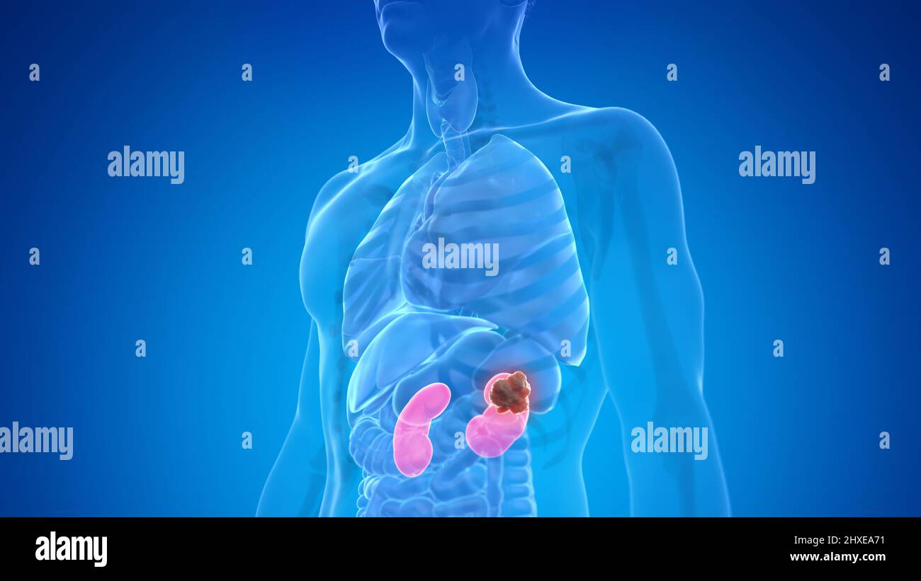 Kidney cancer, illustration Stock Photo - Alamy
