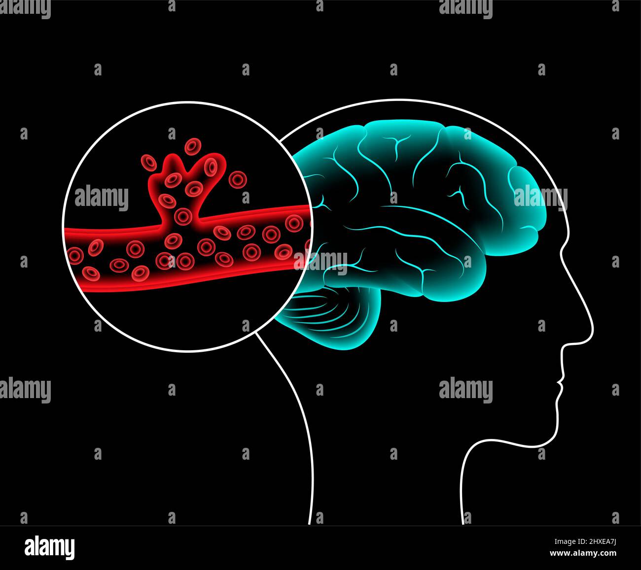 Haemorrhage diagram hi-res stock photography and images - Alamy