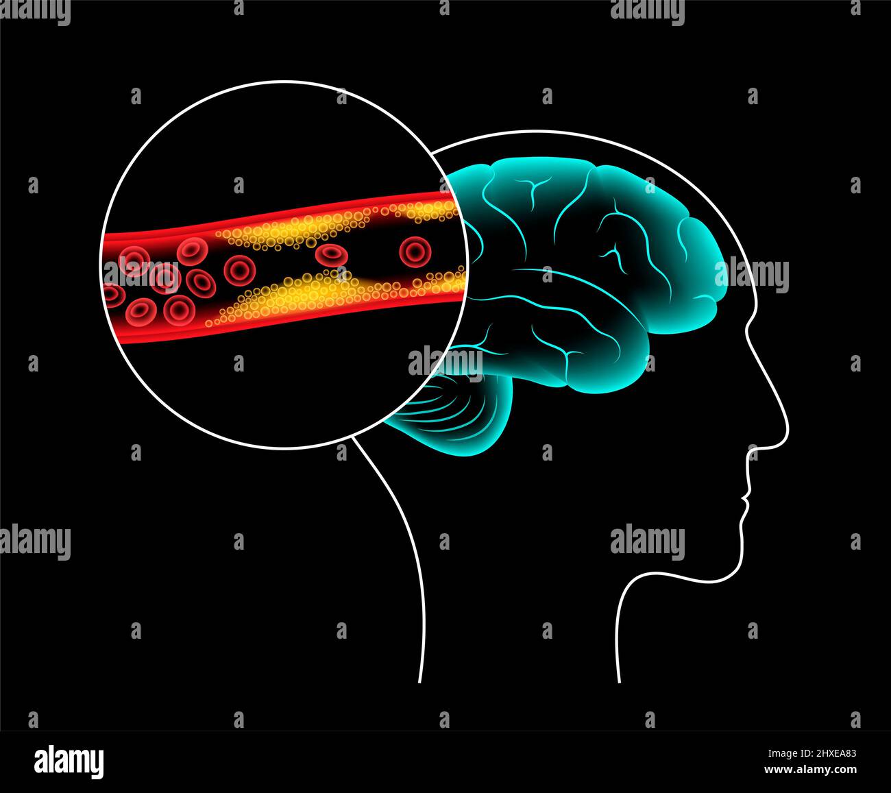 Ischemic infarct hi-res stock photography and images - Alamy