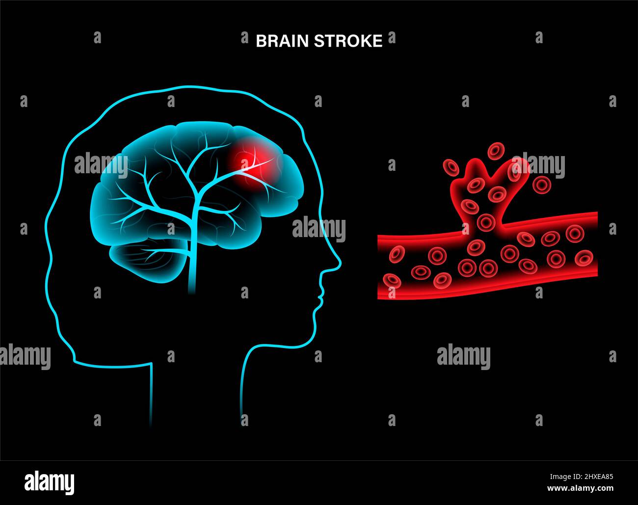 Haemorrhagic stroke, illustration Stock Photo - Alamy