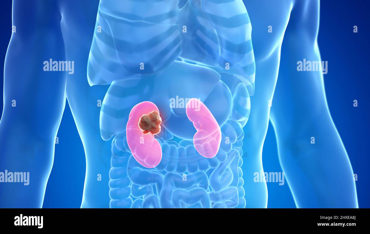 Kidney cancer, illustration Stock Photo - Alamy