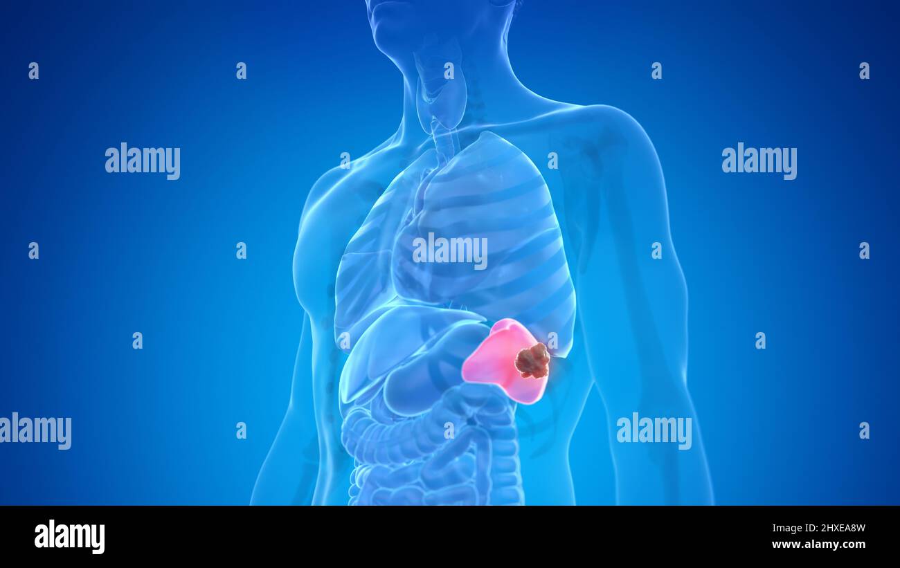 Spleen cancer, illustration Stock Photo - Alamy