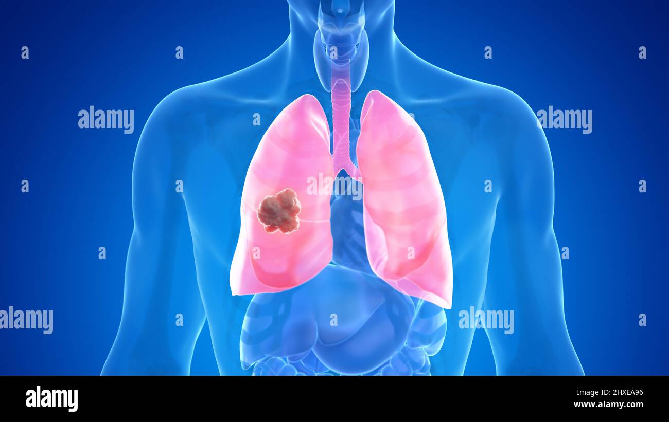 Lung cancer, illustration Stock Photo - Alamy