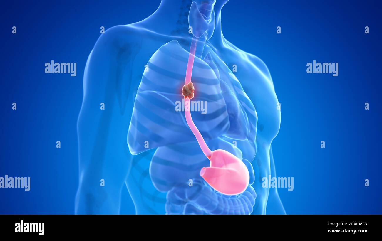 Esophagus cancer hi-res stock photography and images - Alamy