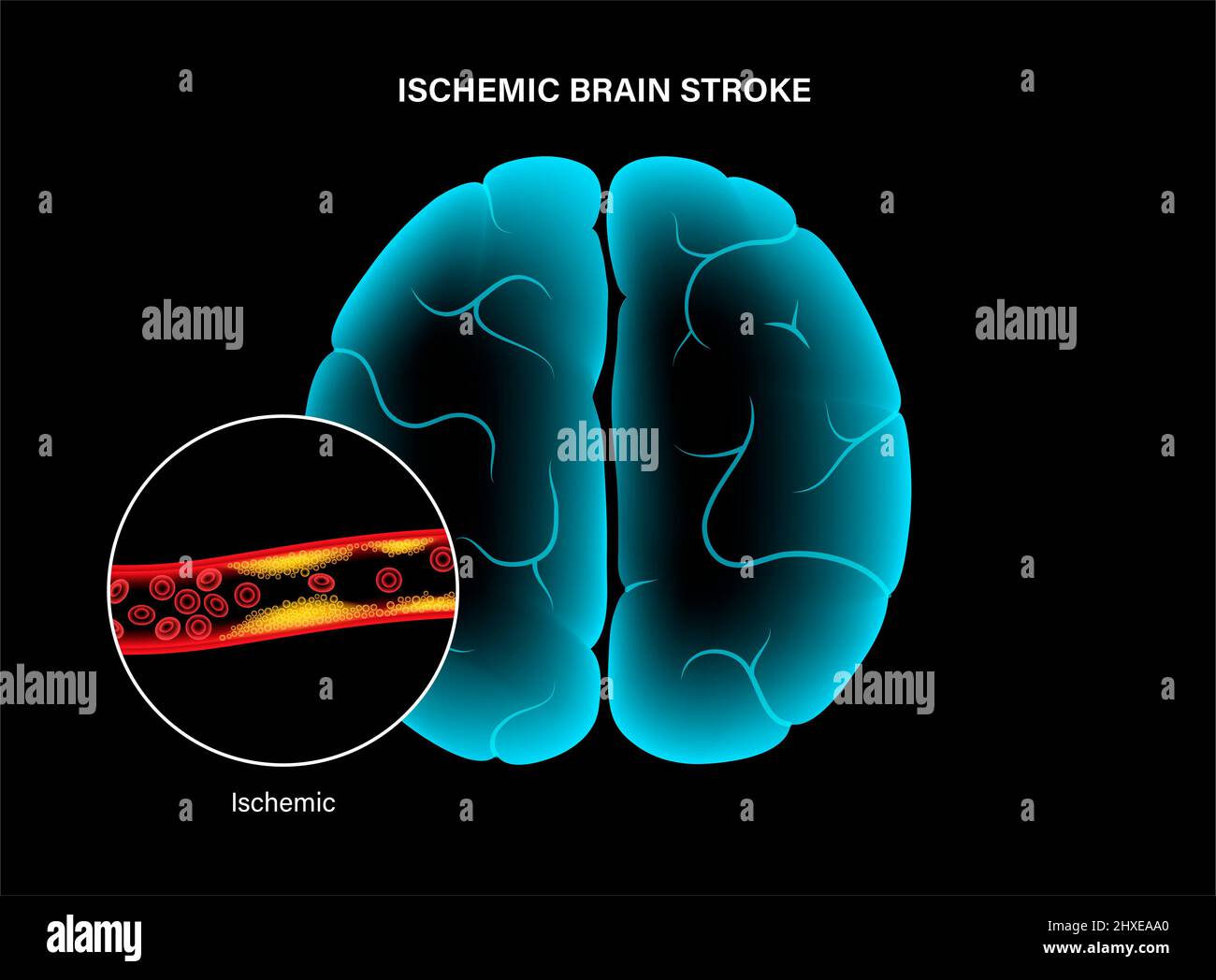 Ischaemic stroke, illustration Stock Photo - Alamy