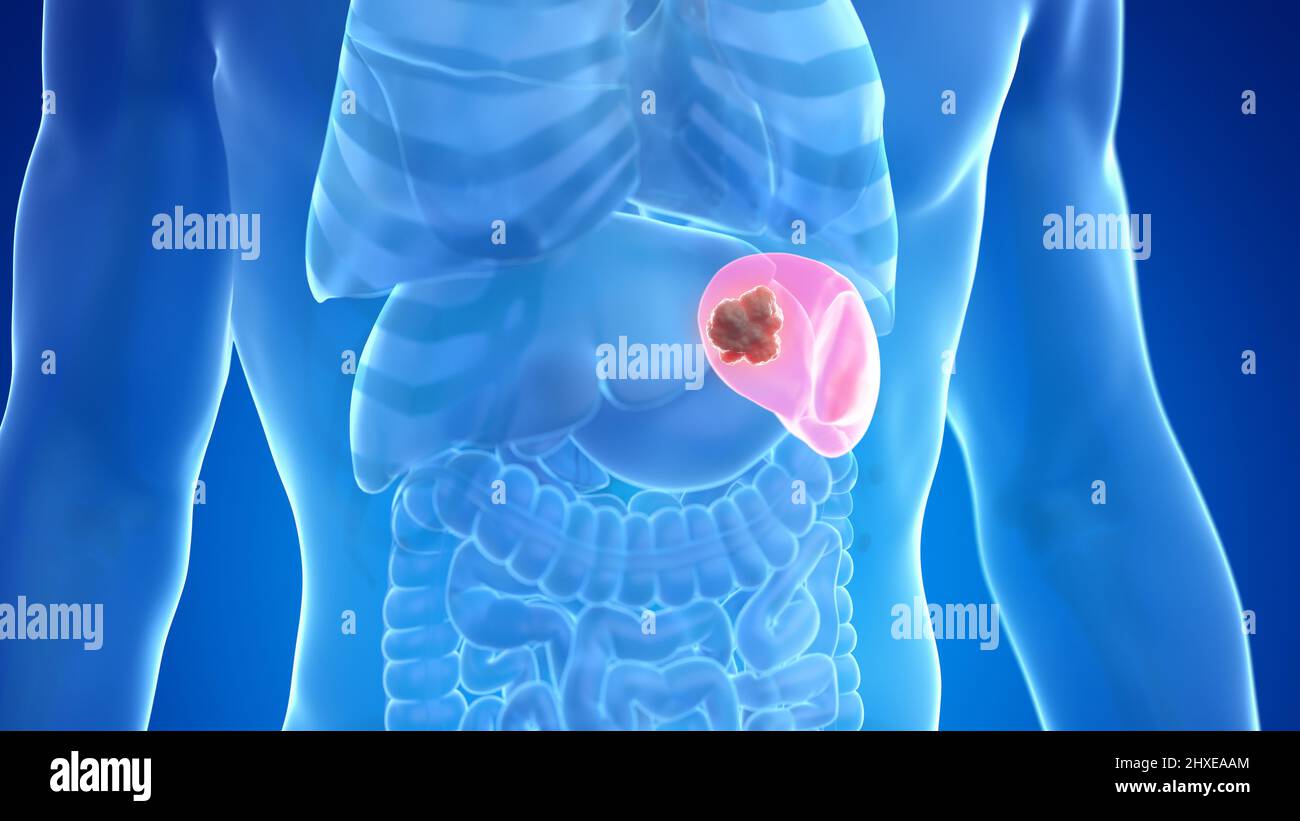 Spleen cancer, illustration Stock Photo - Alamy