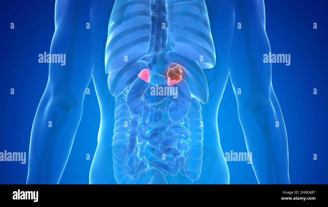 Adrenal gland cancer, illustration Stock Photo - Alamy