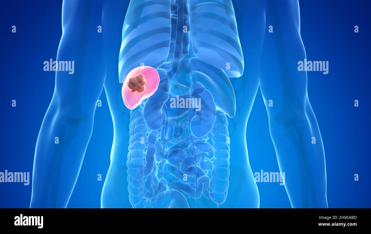 Spleen cancer, illustration Stock Photo - Alamy