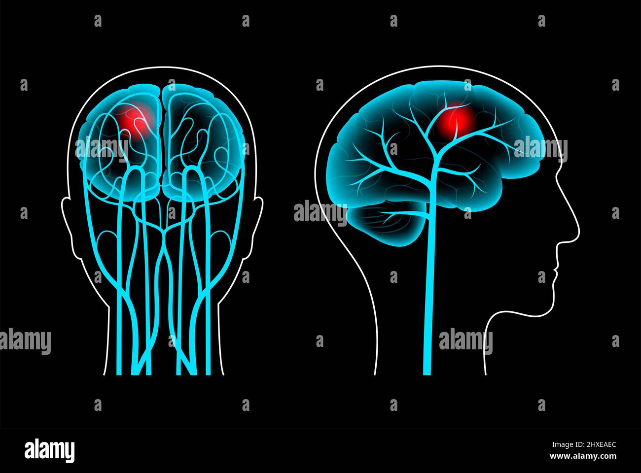 Ischemic stroke hi-res stock photography and images - Alamy