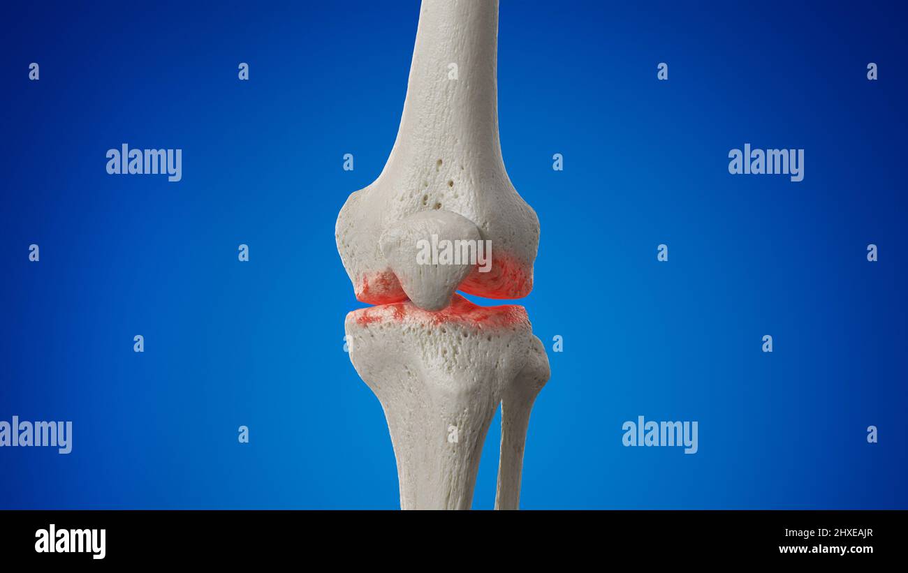 Arthritic joint hi-res stock photography and images - Alamy