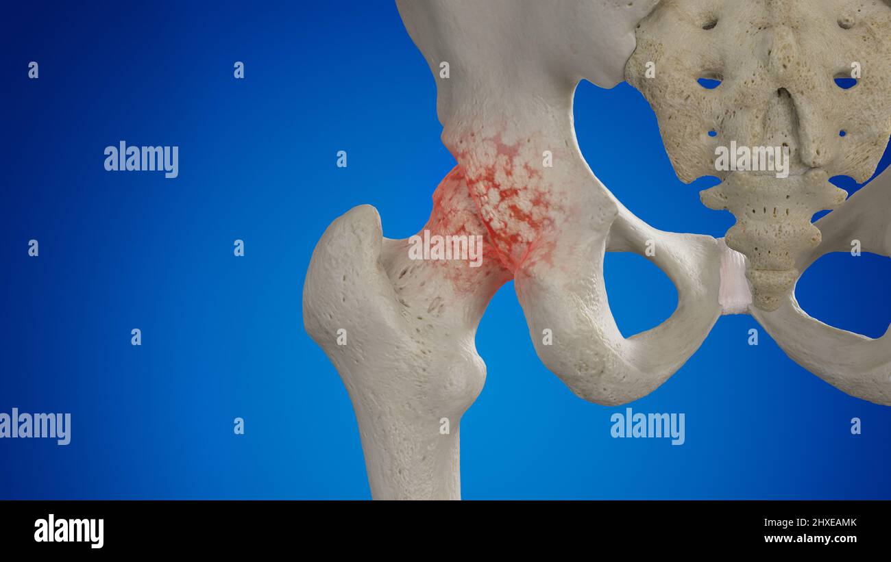 Arthritic hip joint, illustration Stock Photo - Alamy